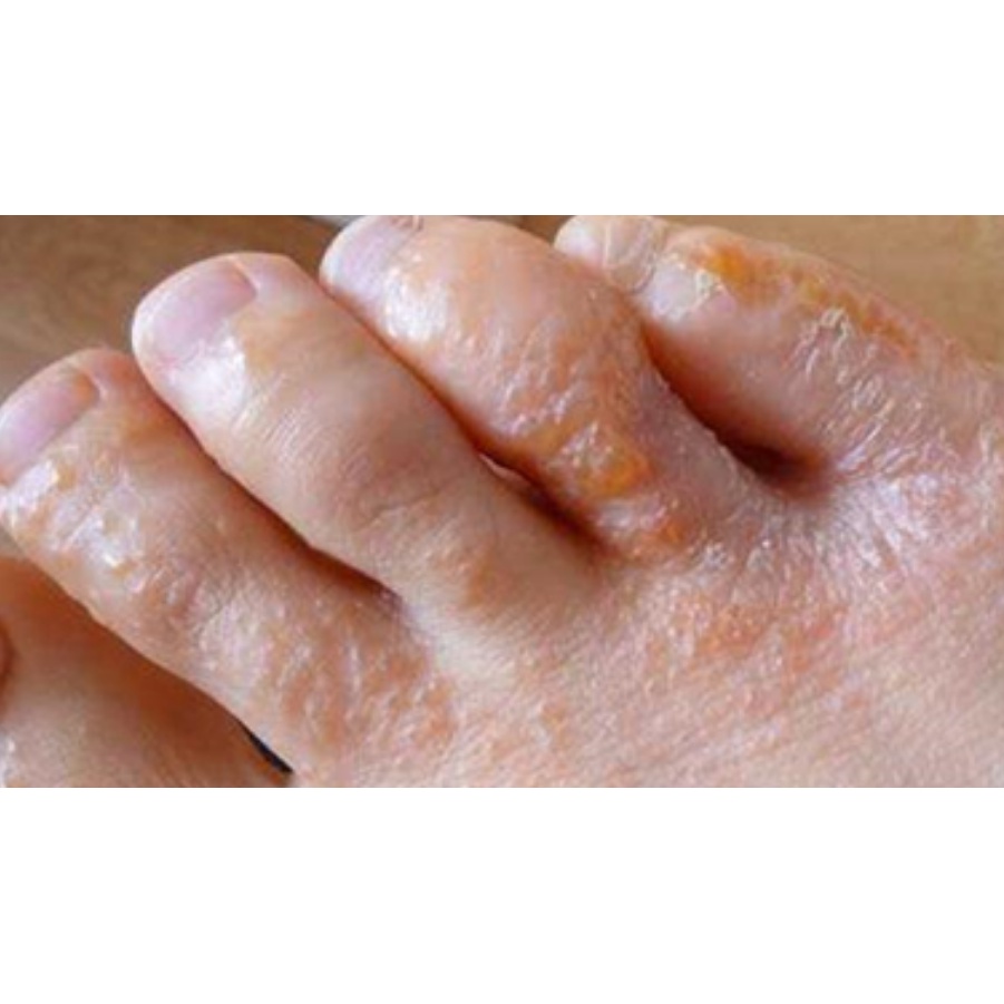 Herbal Immediately Eliminates Scabies, Diarrhea, Foot and Hand Eating ...