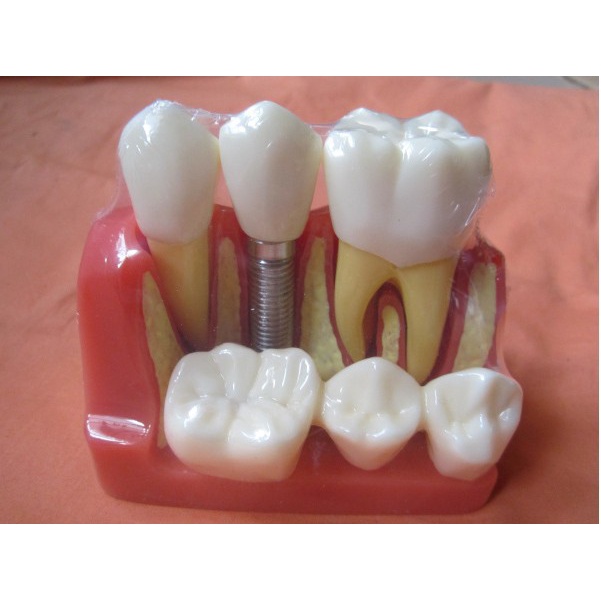 Dental teeth model dental planting teeth model decomposition tooth ...