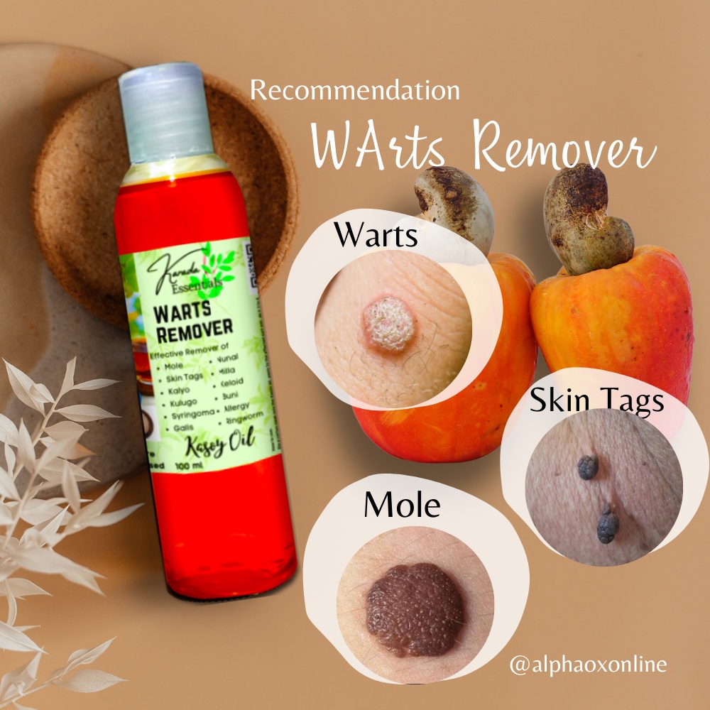 Kasoy oil skin tags warts remover fast Effective Mole kulugo nunal ...