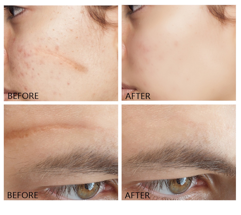 VIBRANT GLAMOUR Upgraded Acne Scar Remover for Face Toner Scar Serum ...