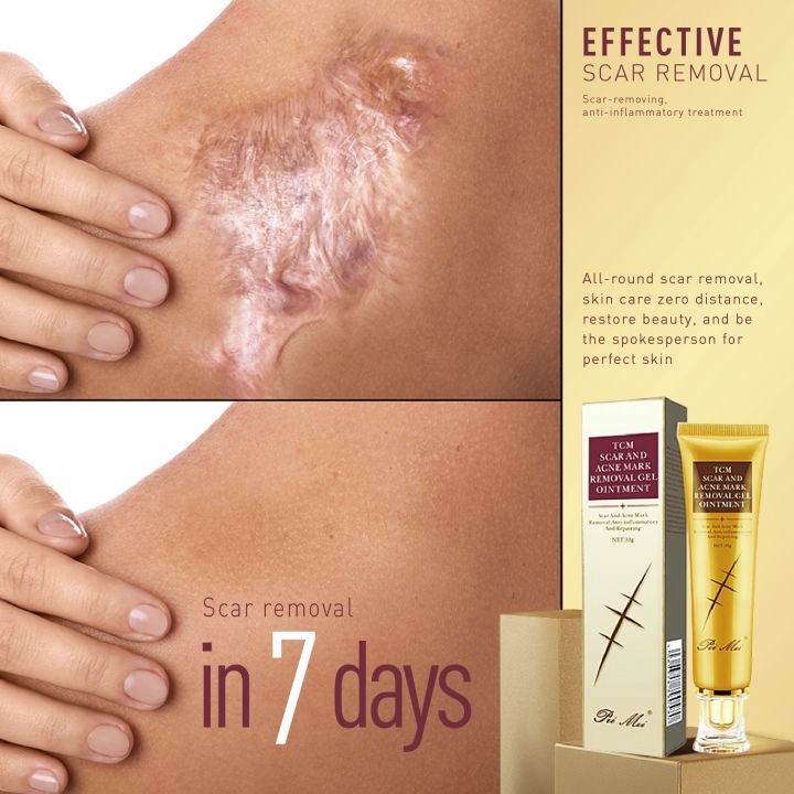 Acne Scar Remover Cream Old Scar Remover Gel Stretch Mark Removal For ...