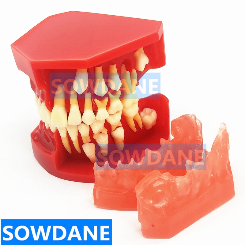 Dental Children Deciduous Teeth Model Replacement Model Permanent Teeth ...