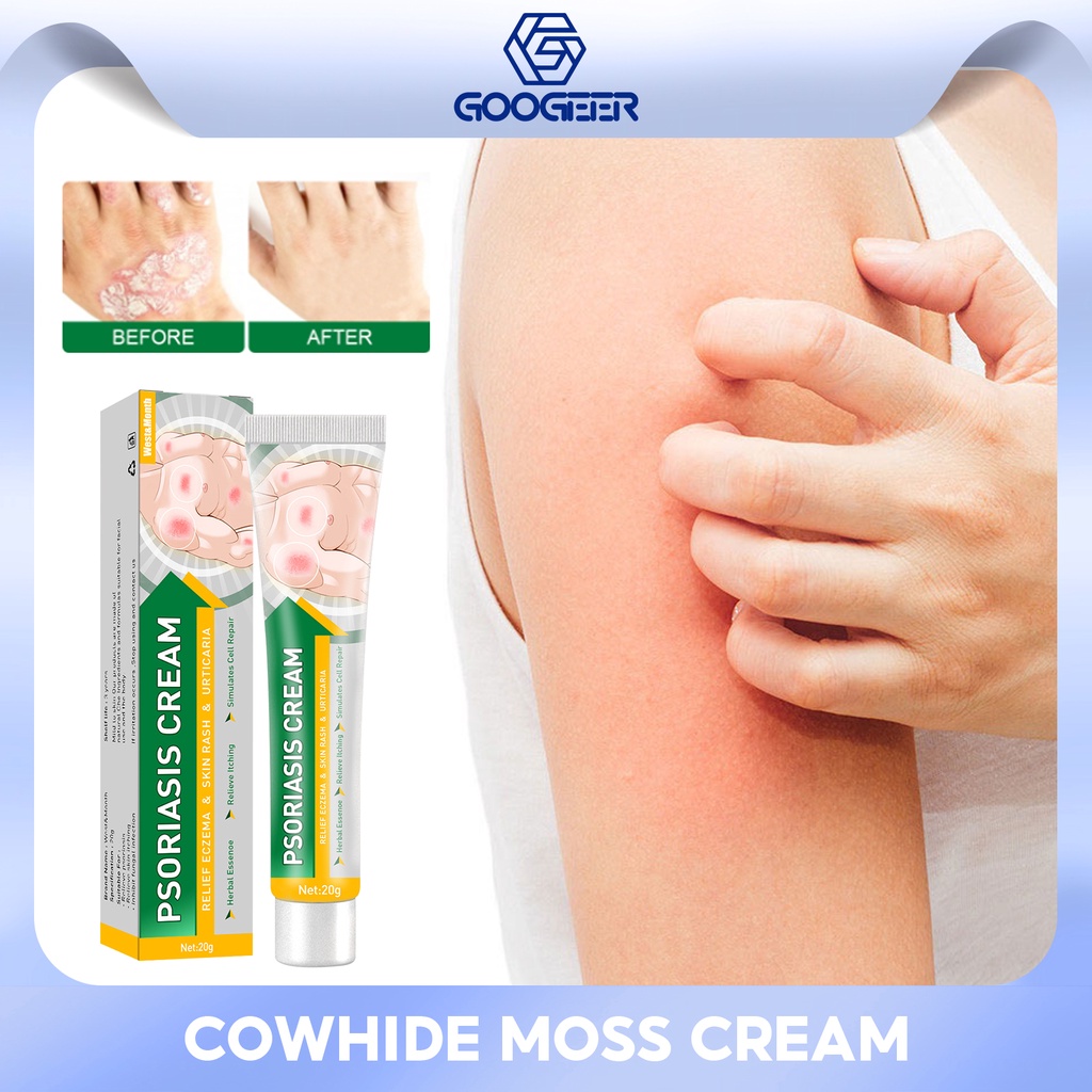 Westandmonth Psoriasis Cream Skin Scalp Ringworm Psoriasis Inner Thigh