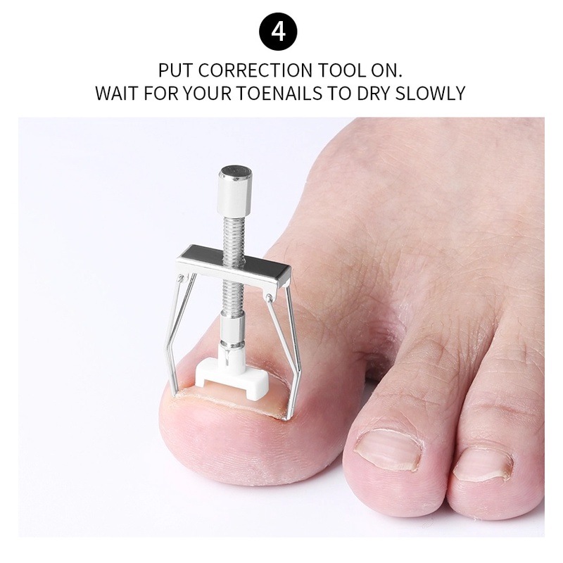 Ingrown Toenail Remover - Safe and Effective Way to Remove Ingrown ...
