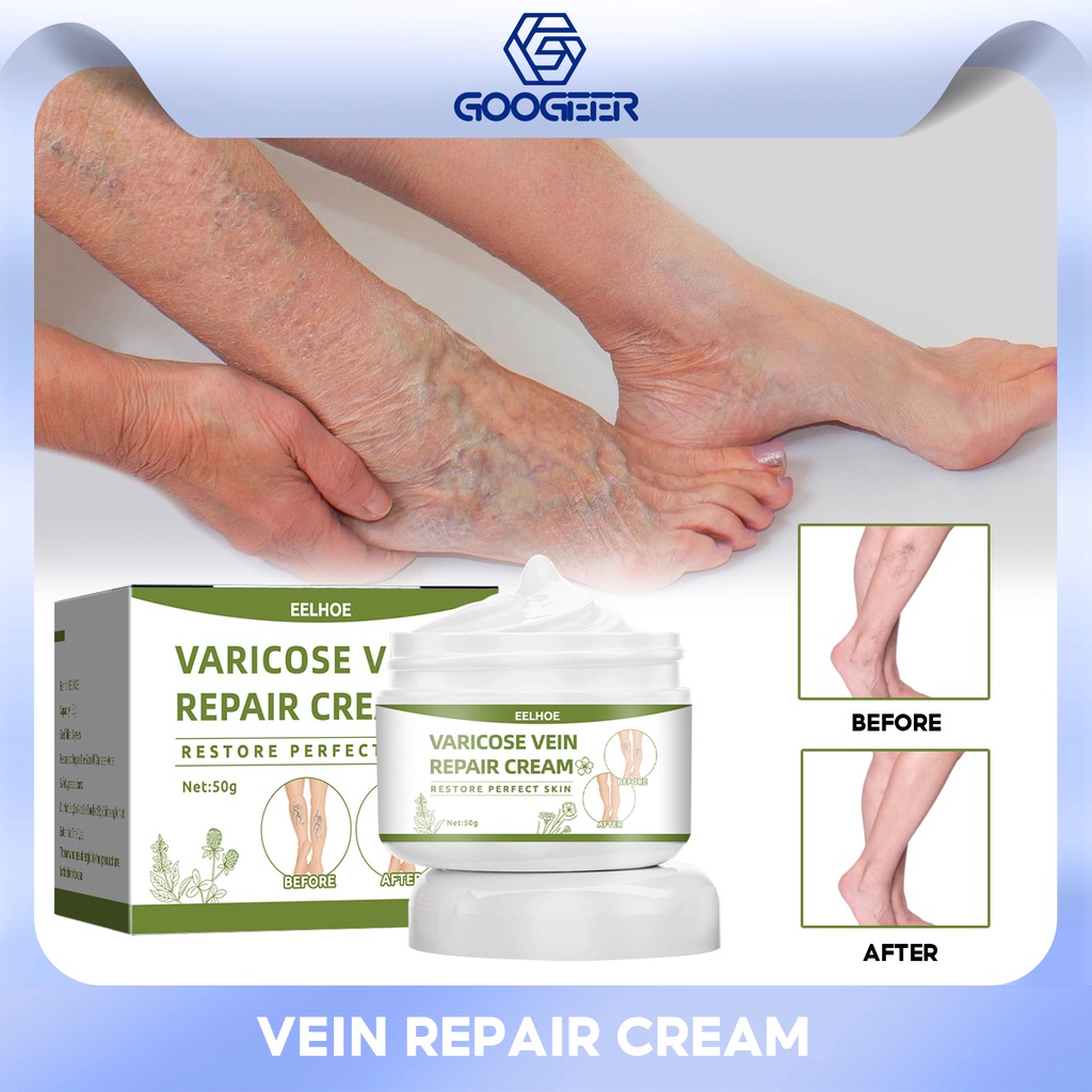 EELHOE Varicose Veins Cream Varicose Veins Ointment Spider Earthworm ...
