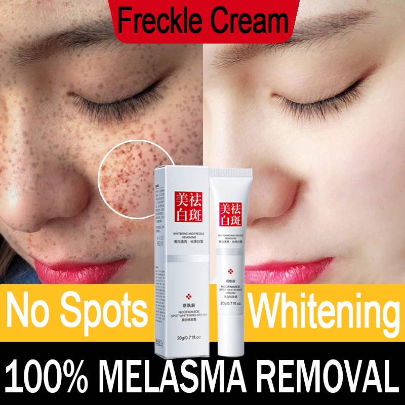 Whitening Freckle Cream Effective freckle removal Remove Melasma Dark ...