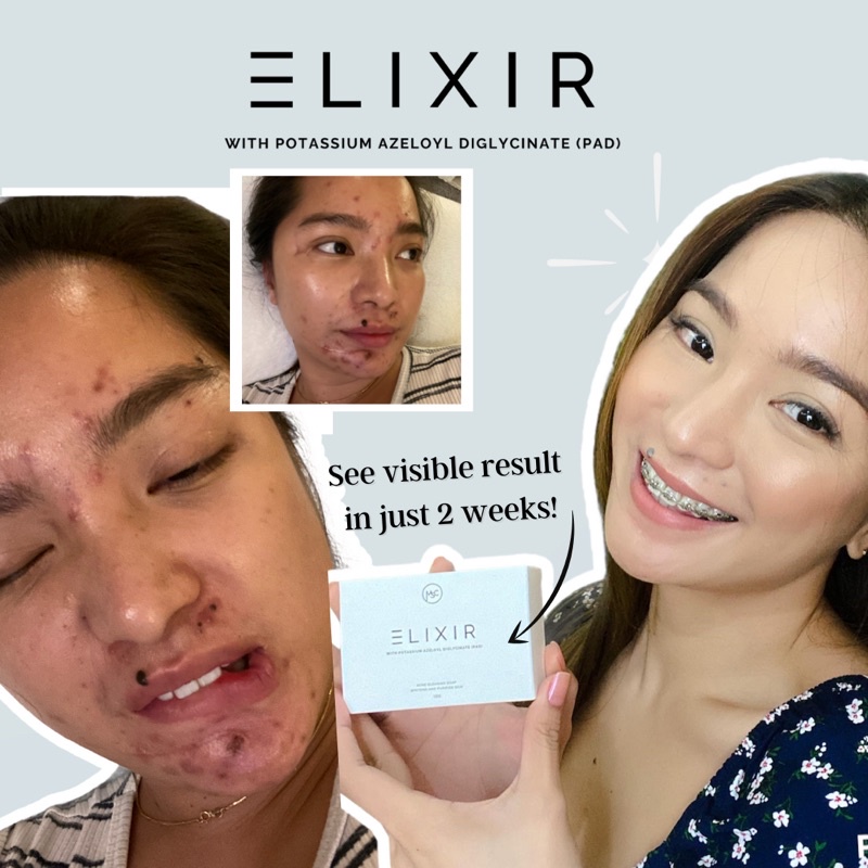 Elixir -acne soap with PAD | Shopee Philippines