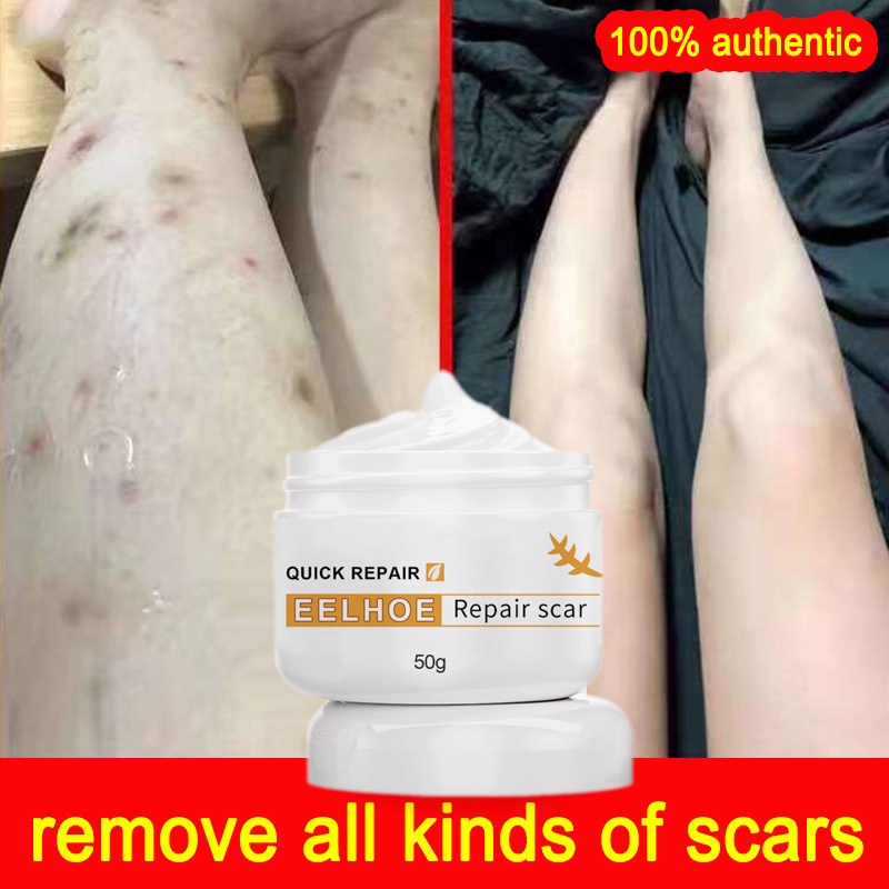 Scars Removal Cream Surgical Stretch Marks Repair Cream Peklat Remover ...