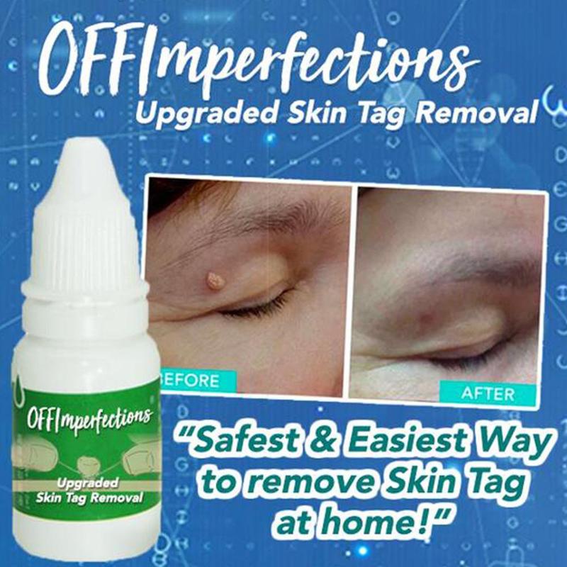 Skin Tag Removal Plantar Genital Warts Ointment Foot Corn Body Warts ...