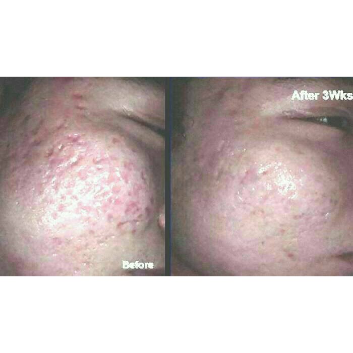 Dermaroller Sps Skins pockmark removal tool / Facial Pockmark Hole ...