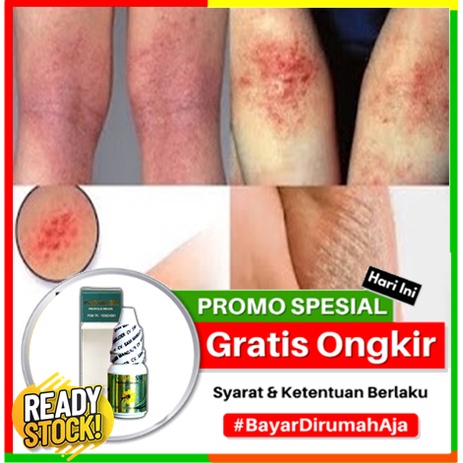 Propolis SM Efficient For Skin Itching Medicines / Skin Infection ...