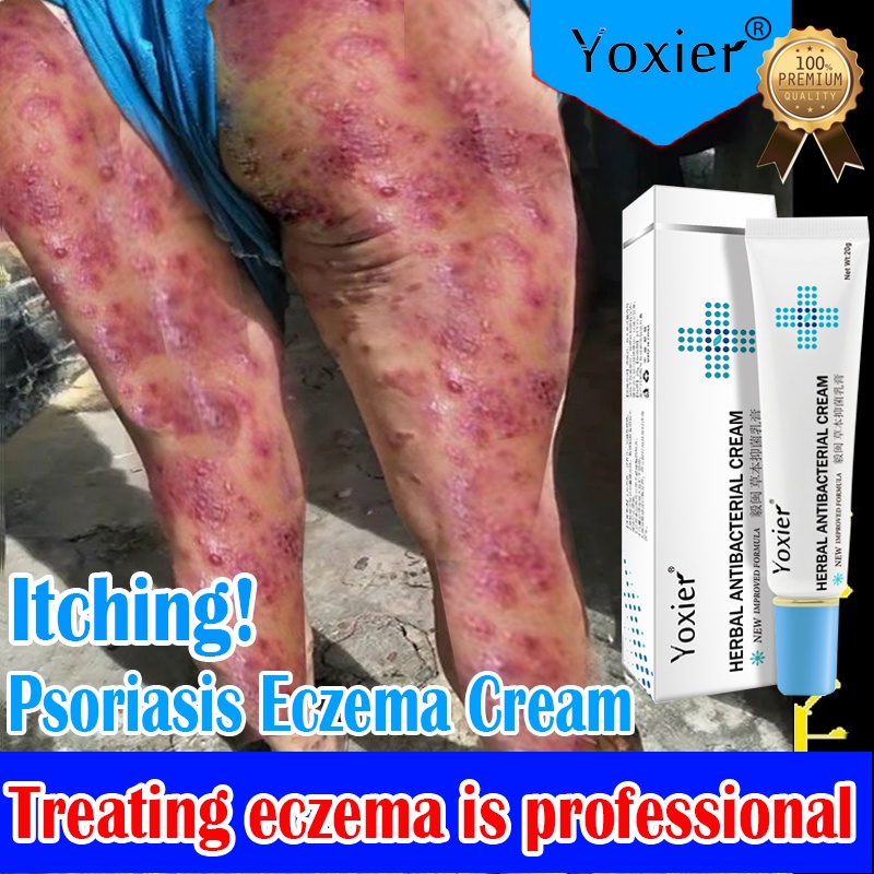 Yoxier Eczema Psoriasis Ointment 20gnatural Cream For Itching Skin Can