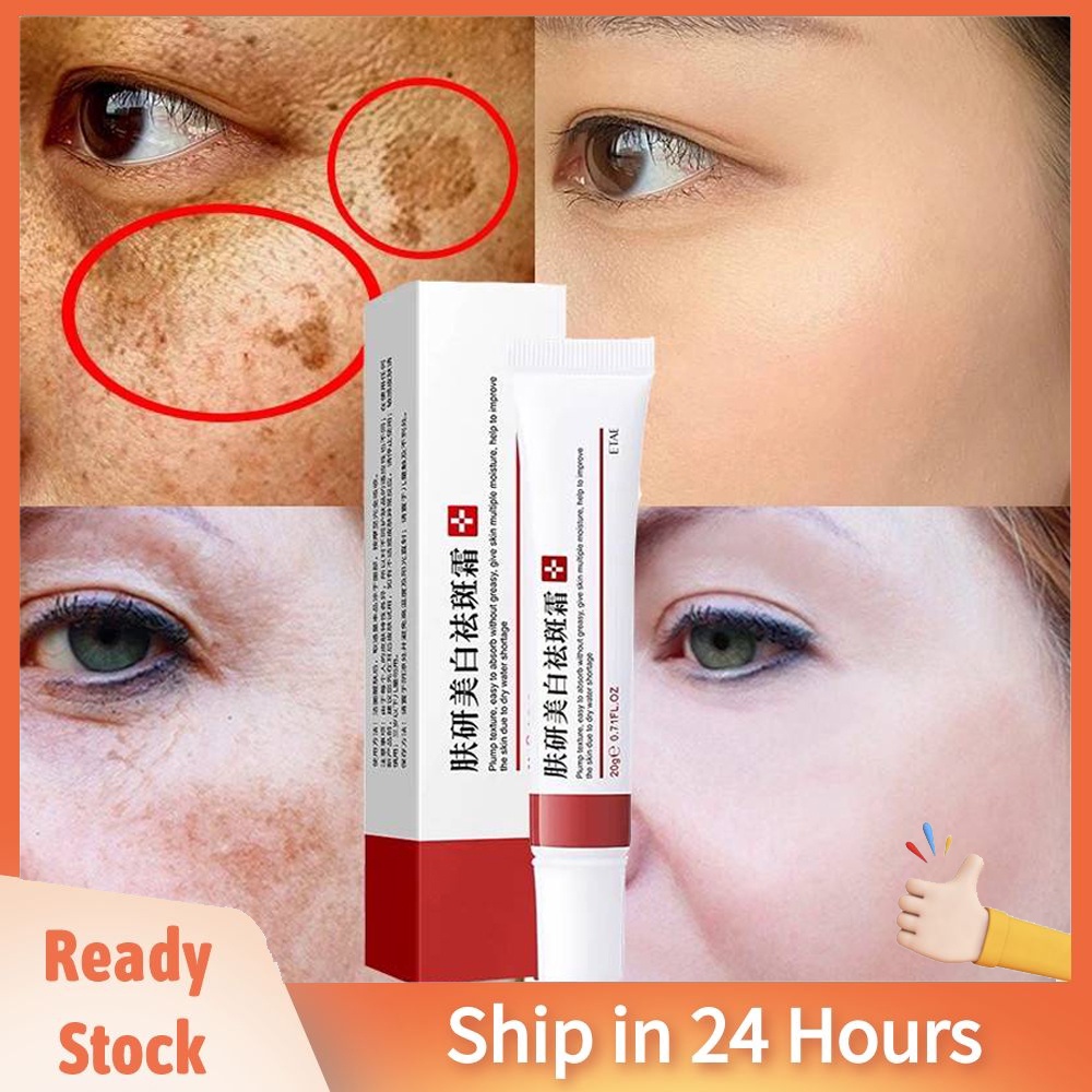 Whitening Freckle Cream Effective Remove Melasma Dark Spots Anti ...