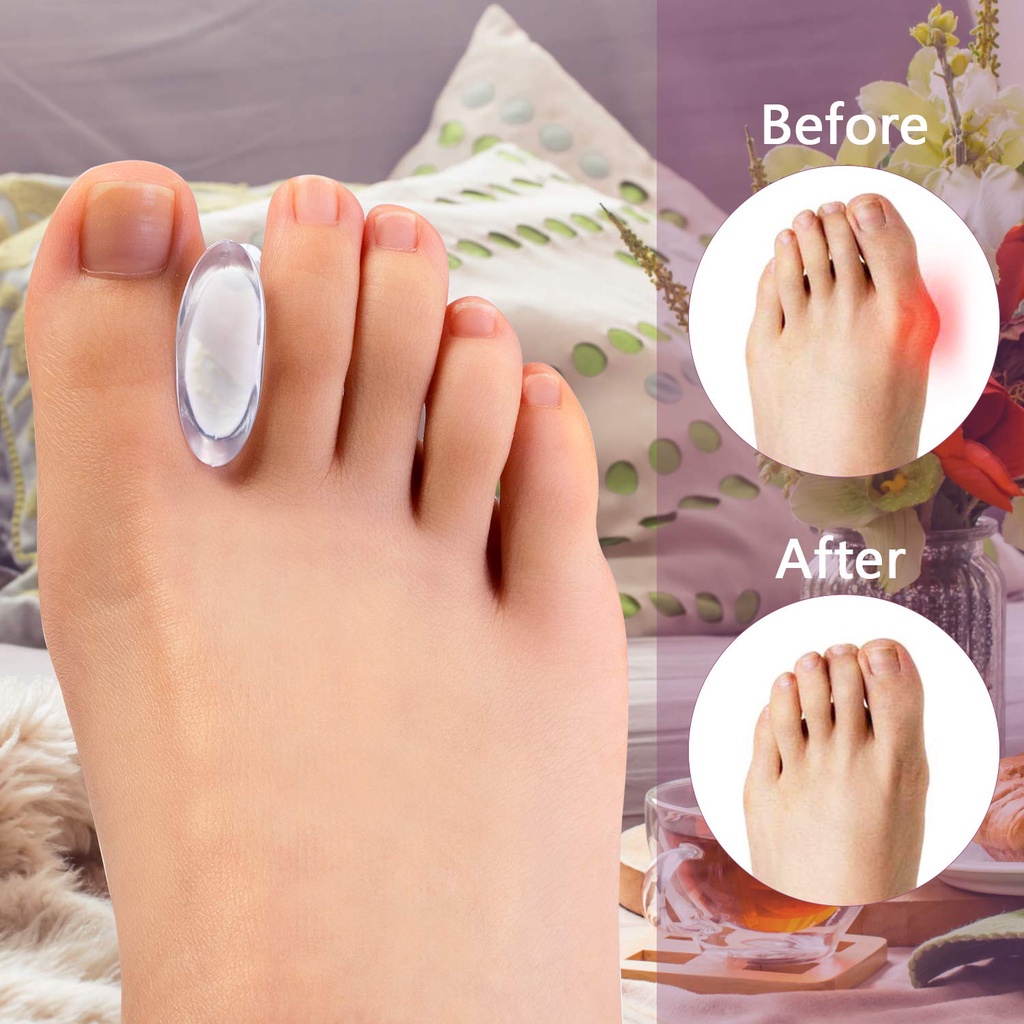 Toe Spacers for Bunion and Corns, Corrector Pads for Crooked Toes ...