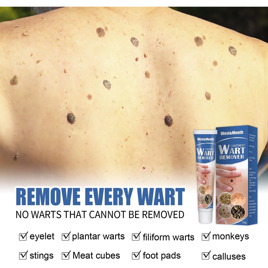Skin Tag Remover Warts Remover Cream Warts cream Wart Cream Skin ...