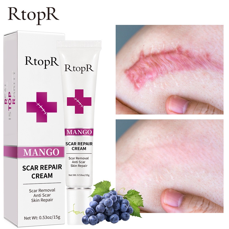RtopR Scar repair cream 15g Scar remover Anti scar Skin repair cream ...