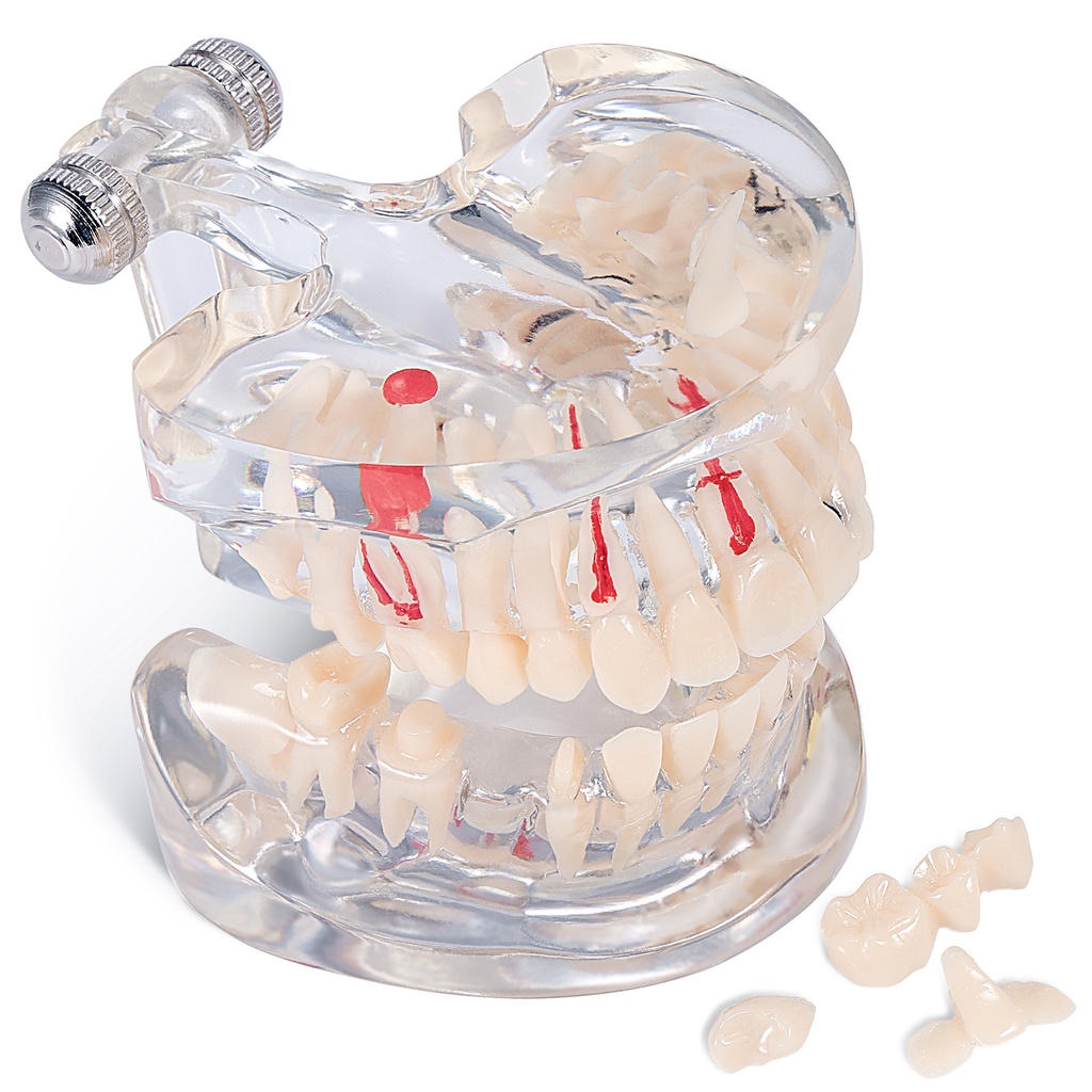 Dental Teeth Model Disease Transparent Pathological Study Model ...