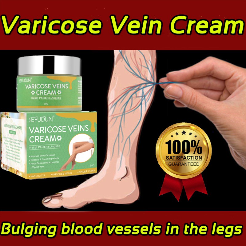 Varicose Cream Varicose Vein Remover treatment Varicosity Angiitis ...