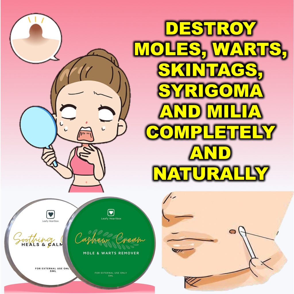 Cashew Cream (5 ml) Mole Warts Skintags Kulugo Milia and Syrigoma ...