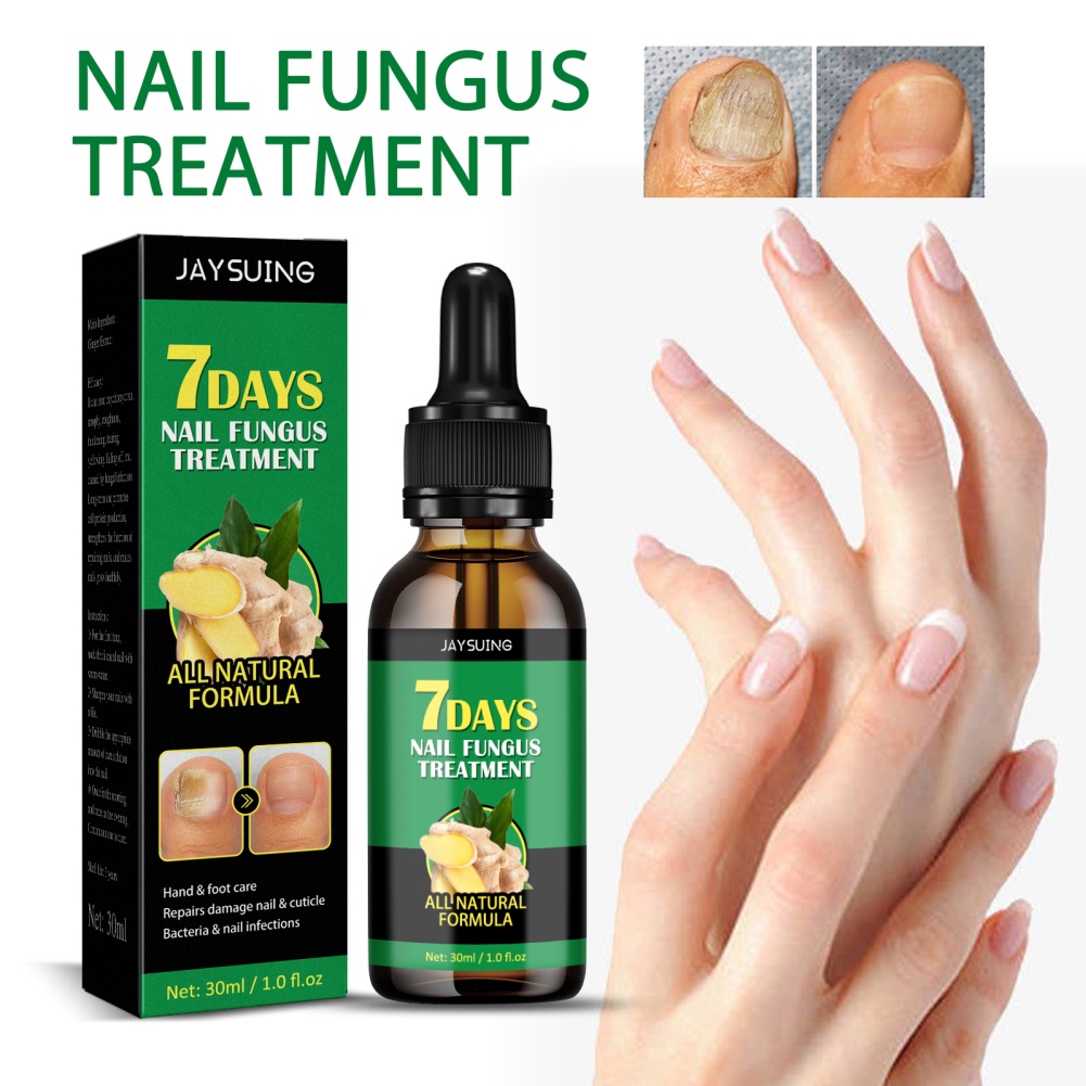 Jaysuing Ginger Nail Care 7 Days Fungal Treatment Feet Care Essence Anti Infection Paronychia ...