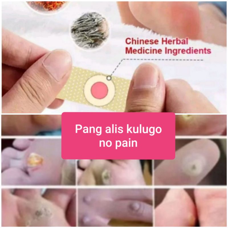 Breadmaxine 8 Patches Alis Kulugo Callus Remover Corn Remover Wala ...