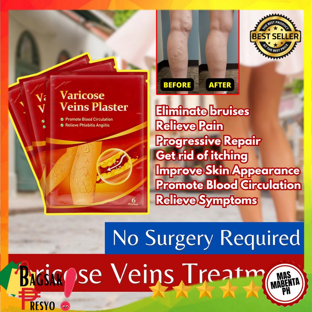 Varicose Patches Effective Remover Spider Veins Pain Treatment Plasters ...