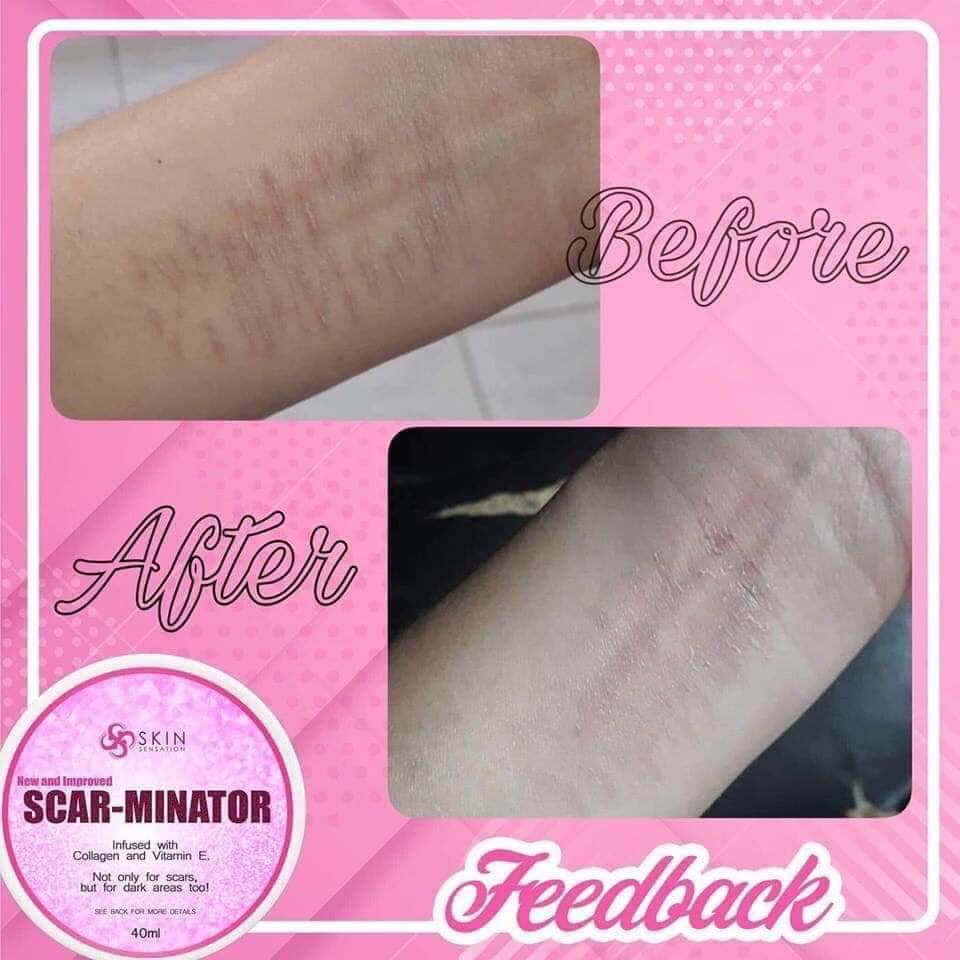 SKIN SENSATION Cream Scarminator Remover Scar Removal Peeling Collagen ...