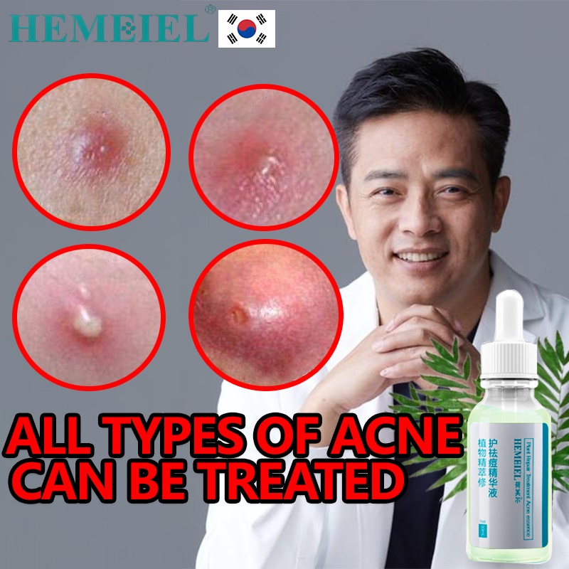 HEMEIEL Pimple Eraser/Pimple Remover/Pimples And Acne Remover/Acne ...