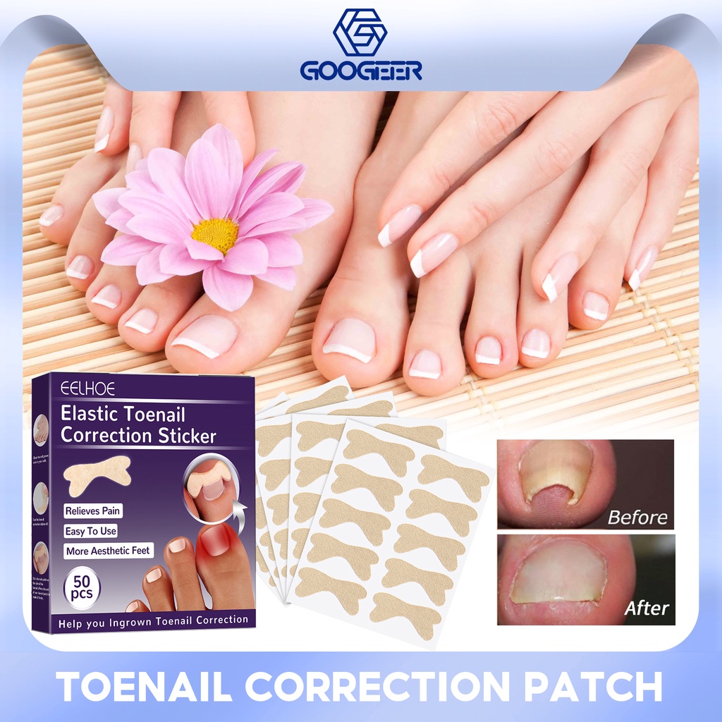 EELHOE Elastic Toenail Correction Stickers Ingrown Toenail Corrector ...