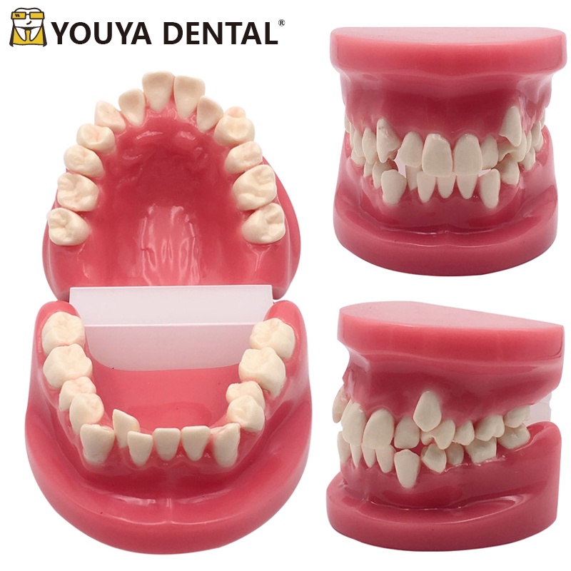 Tooth Misalignment Model Dental Student Tooth Misalignment Exercise ...