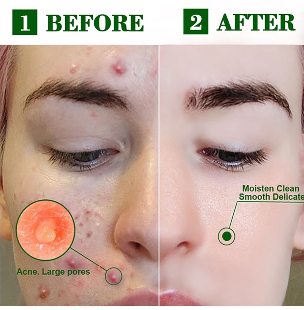 MABREM Peptide Acne Treatment Essence with Salicylic Acid and Tea Tree ...