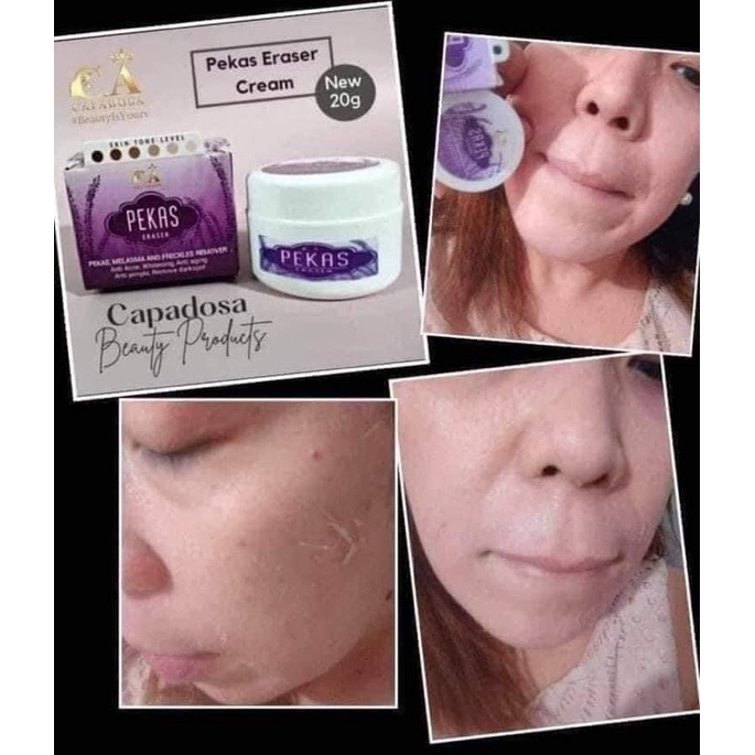 (WITH FREEBIES) Pekas Eraser (Pekas, Melasma & Freckles Remover) by ...
