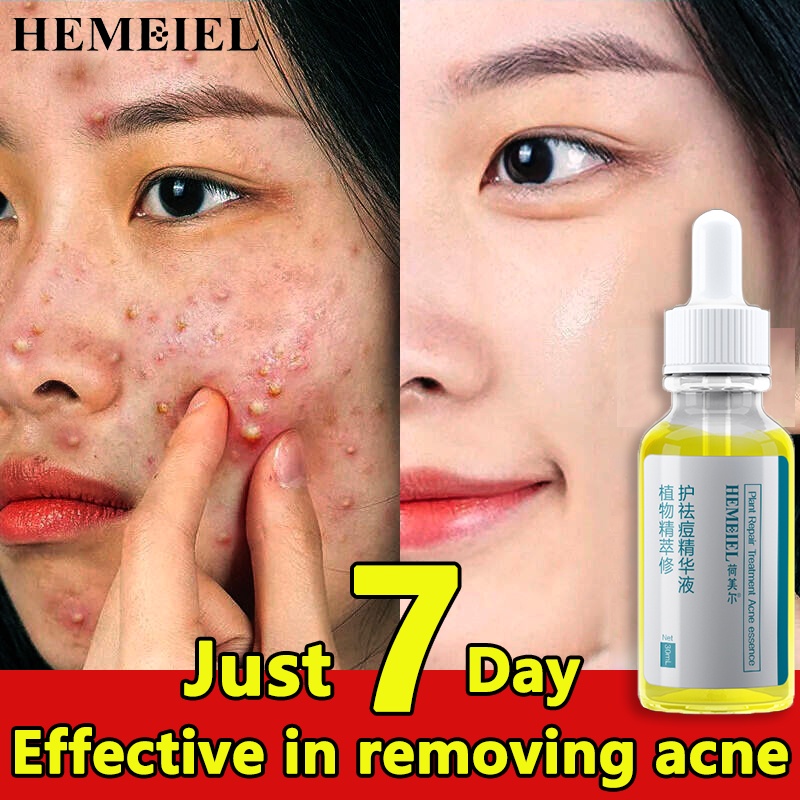 HEMEIEL Acne Scar Remove/Pang Tanggal Ng Pimples/pimples acne remover ...