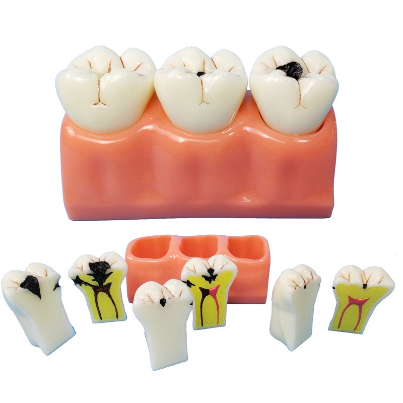Dental Caries Disassembling Model 4 Times Denture Disease Teeth Model ...