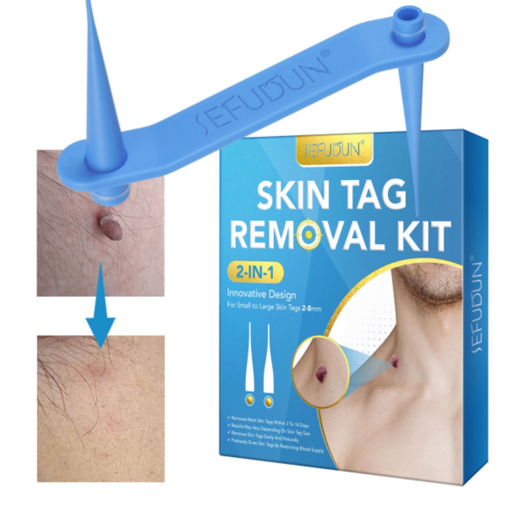 Skin Tag e Kit Creative Physical Remove Neck Small Meat Pellets Neck ...