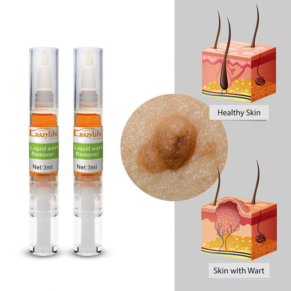 Wart Remover Painless Skin Tag Mole Remover Device for Medium Large ...