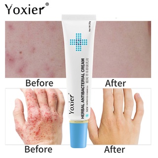 20g Yoxier Herbal Antibacterial Cream Psoriasis Cream Anti-itch Relief ...