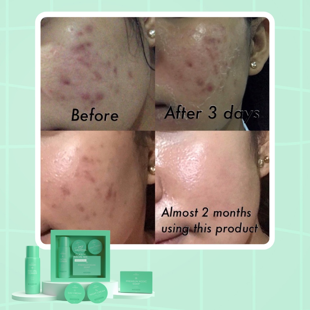 FDA Approved Clarity Essentials Set - Clarity Facial Set - Pimple ...