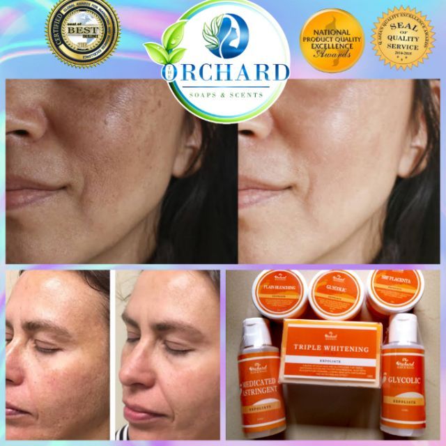 Melasma Treatment Set (Treatment for melasma, freckles and ...