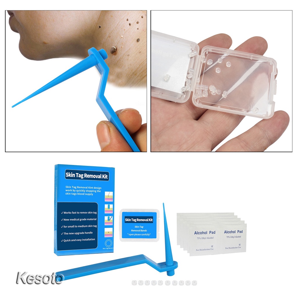 Skin Tag Removal Kit Kill Skin Mole Wart Remover Micro Band Remove Skin ...