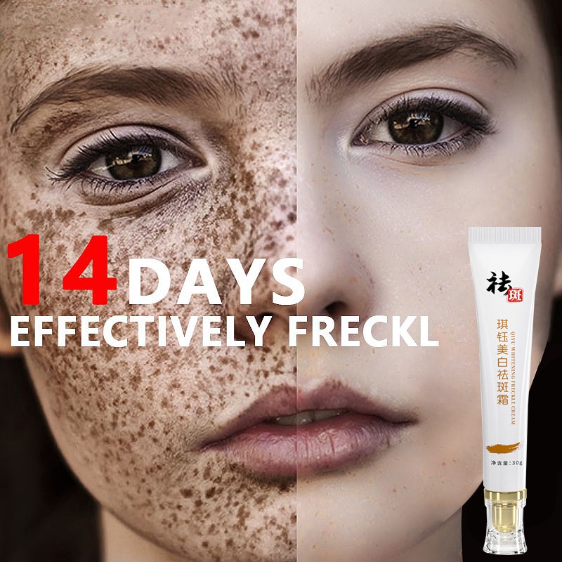 Freckle cream Whitening Cream face cream 30g Powerful remove freckles ...