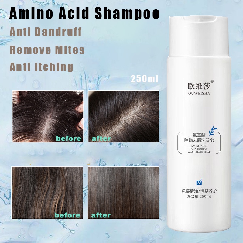 Amino Acid Shampoo Anti Dandruff Shampoo Removal Mites Scalp Itching ...