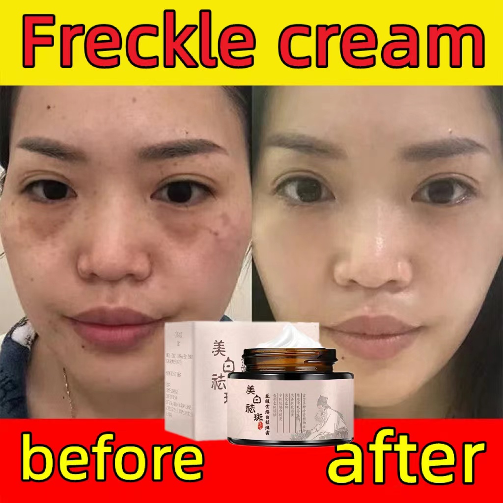 Freckle Remover Cream Pigmentation Remover Cream And Dark Spot Black ...