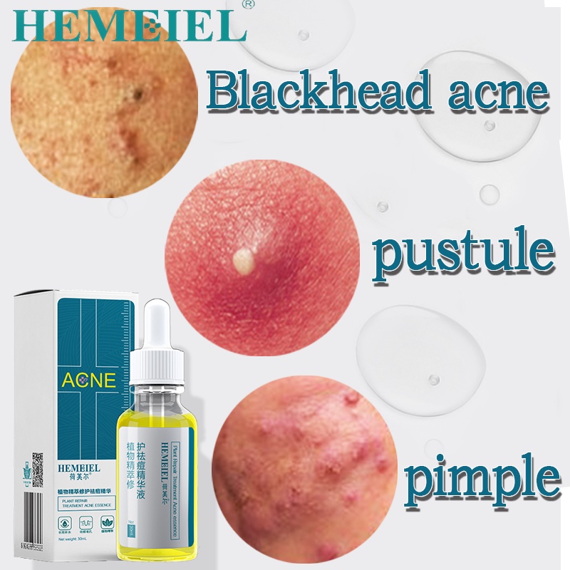 HEMEIEL- Plant acne repairing cream,acne scar remover pimple marks ...
