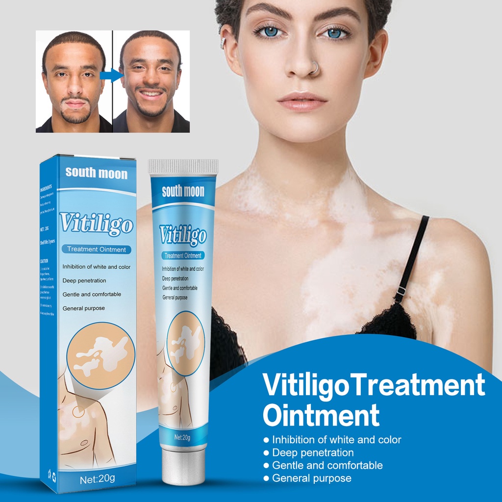 20g Vitiligo Treatment Cream Remove White Spots Ringworm Leukoplakia ...