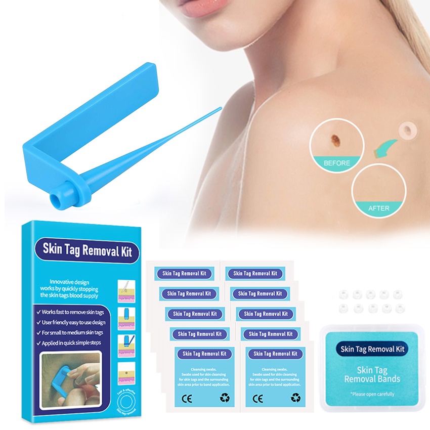 31pcs Micro Tag Band in Skin Tag Remover Kit Non Toxic Face Care Mole ...