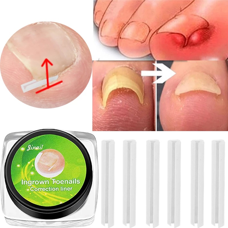 1 Box Nail Art Ingrown Toenails Correction Wire / Straightening Pad ...