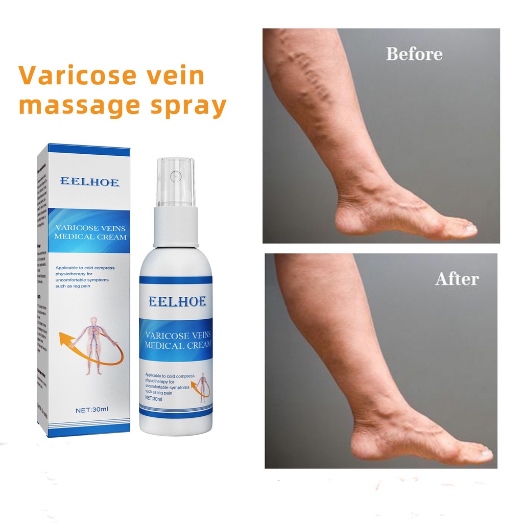 EELHOE Varicose Vein Soothing Sprays Vasculitis Phlebitis Spider Leg ...