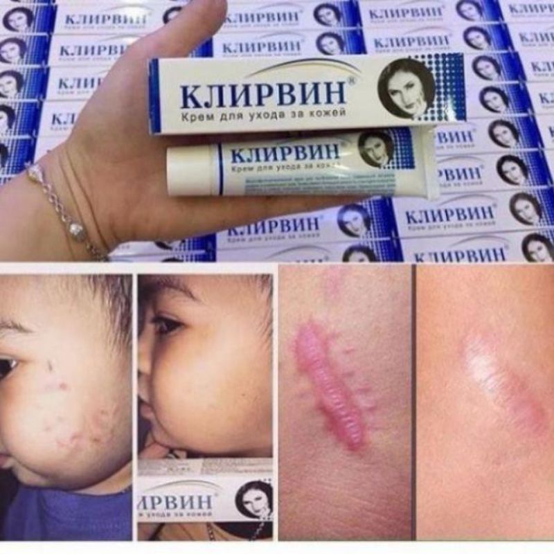 Klirvin Clearwin Herbal Cream for Stretch Mark and Scars Removal, 25g ...
