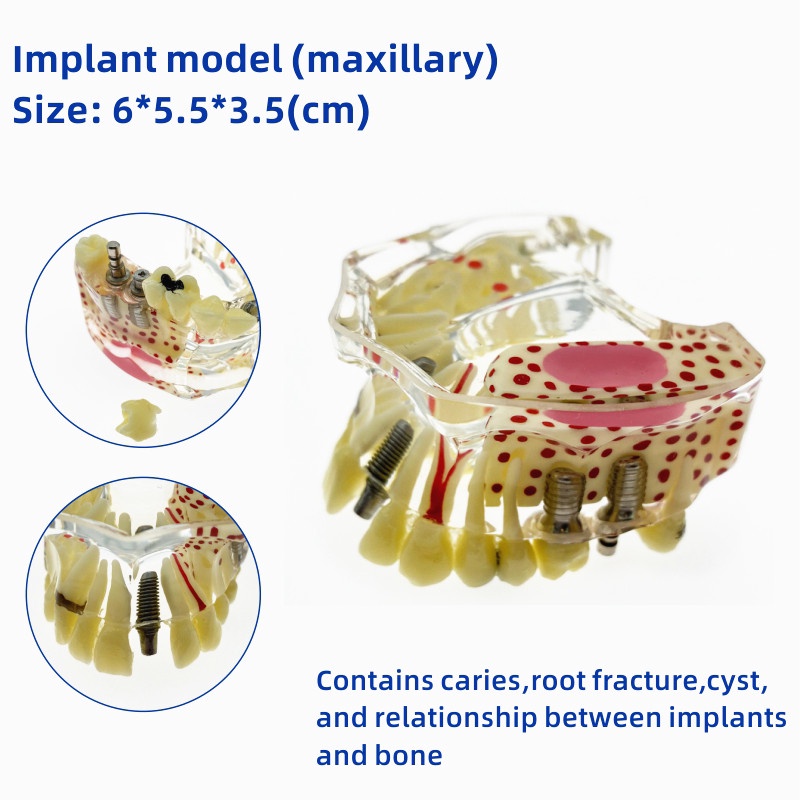 Dental Implant Upper Jaw Model With Bridge & Caries Dental Study Teach ...